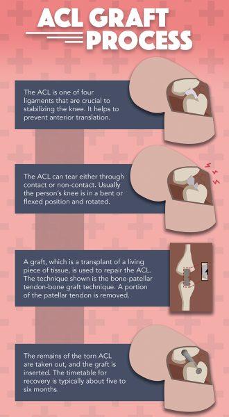 ACL Graft Process – The UTD Mercury